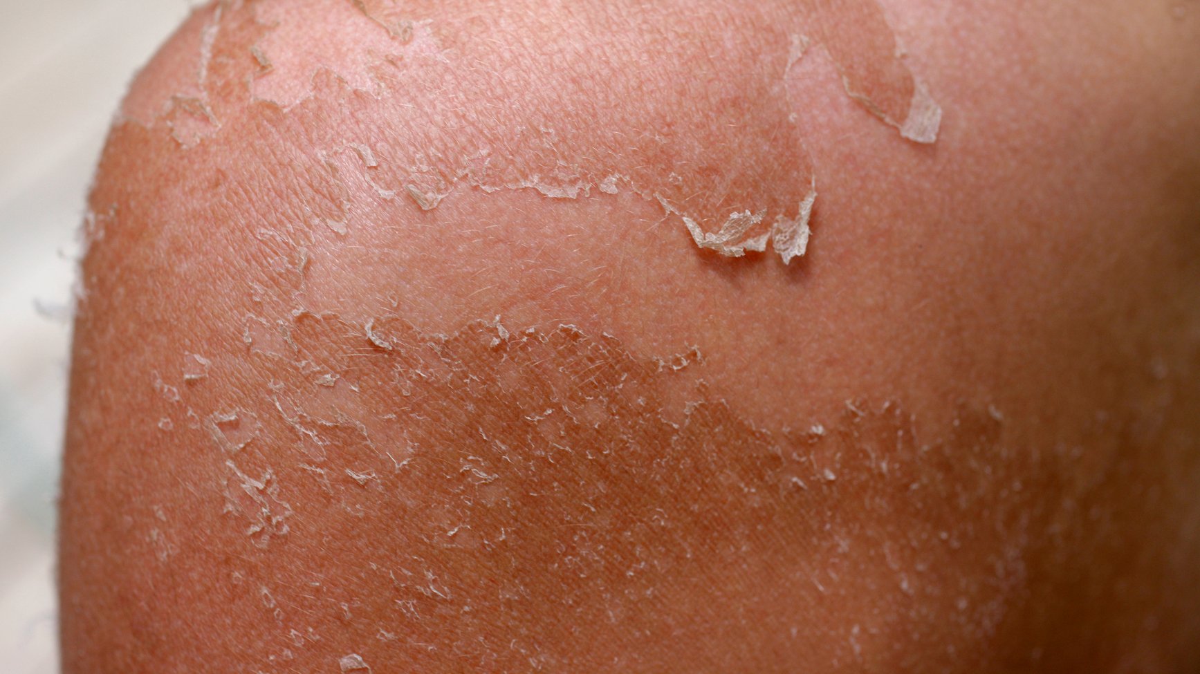 focal hyperpigmentation and