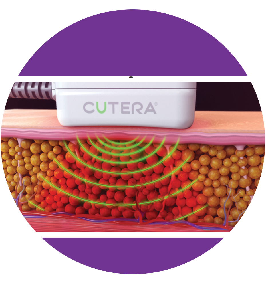 Cutera truSculpt iD NA