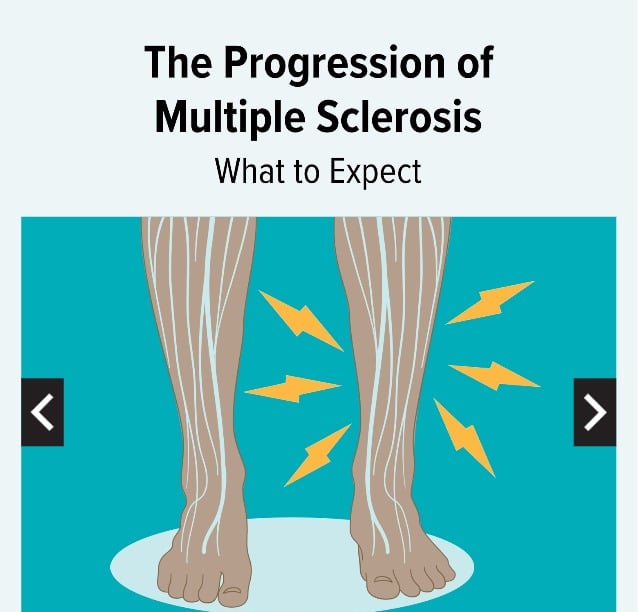 The Progression of Multiple Sclerosis