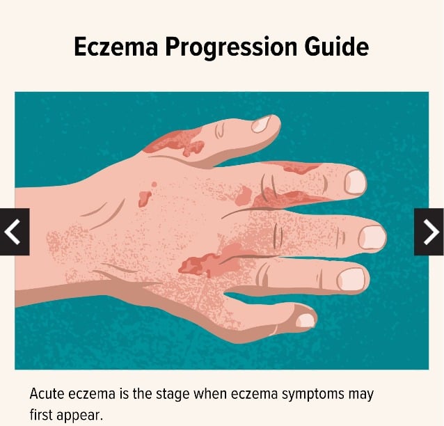 HL Eczema Progression Guide