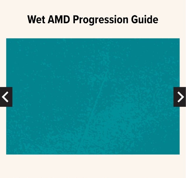 HL Wet AMD Progression Guide Wet AMD Progression